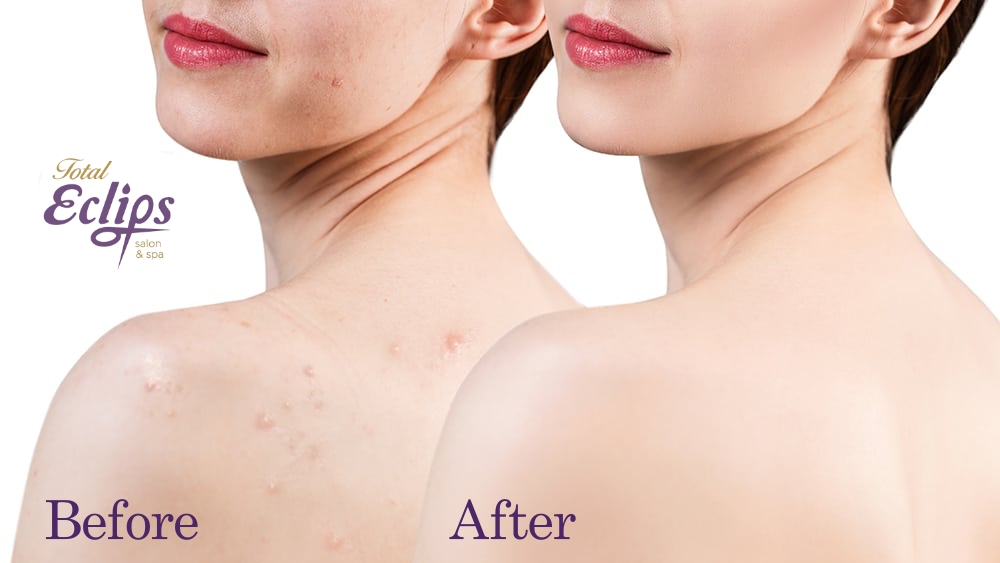 Back Facials - Total Eclips Salon & Spa